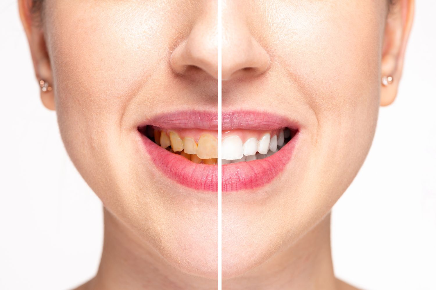 Tudomány a mosoly mögött: mitől vonzó egy mosoly? | Hattyas Dental